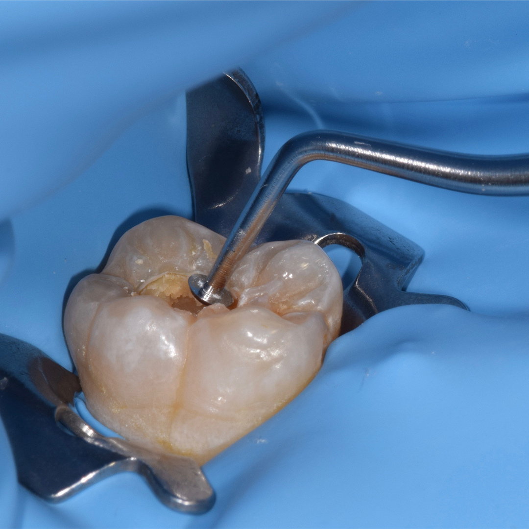 The selective carious tissue removal approach • Deppeler SA